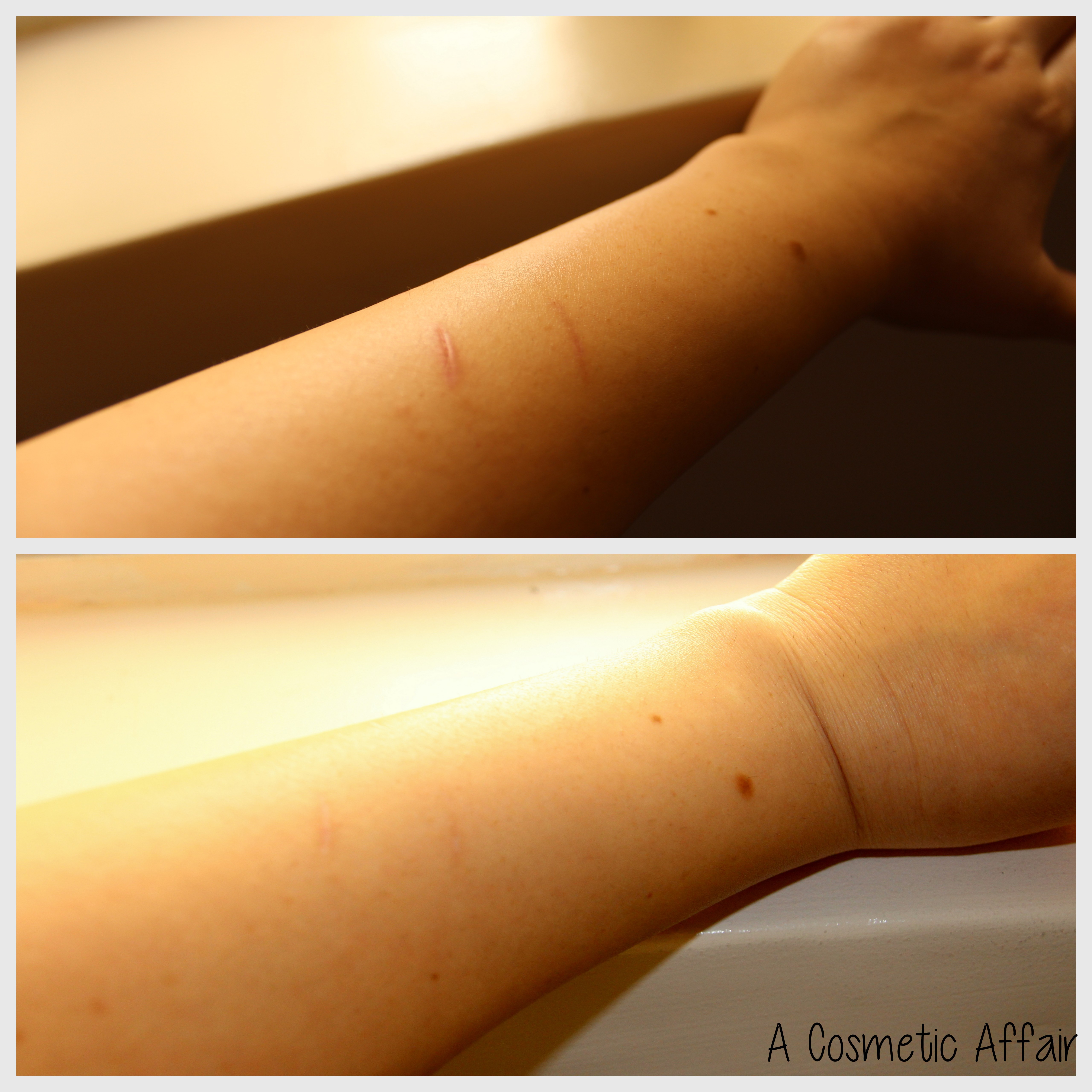 My experience with Bio-Oil – A Cosmetic Affair